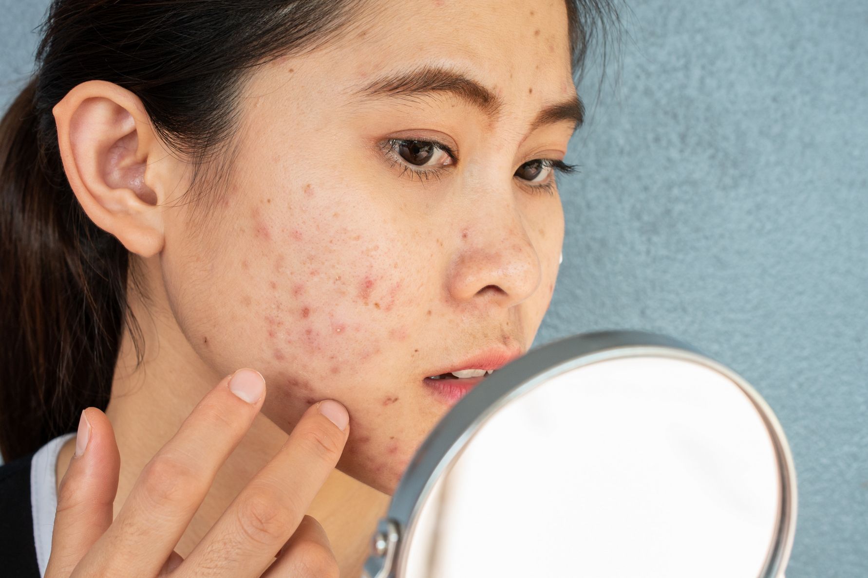 Natural Acne Treatments: A Naturopathic Approach to Clear Skin